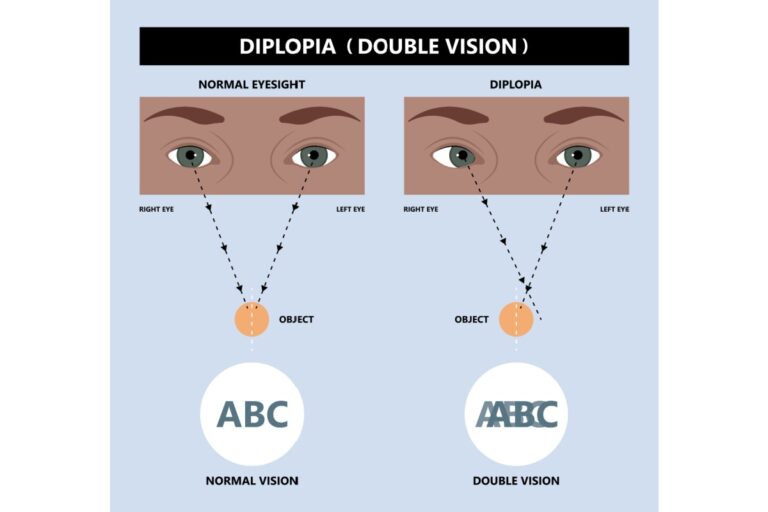 How Eye Muscles Affect Your Alignment & Vision